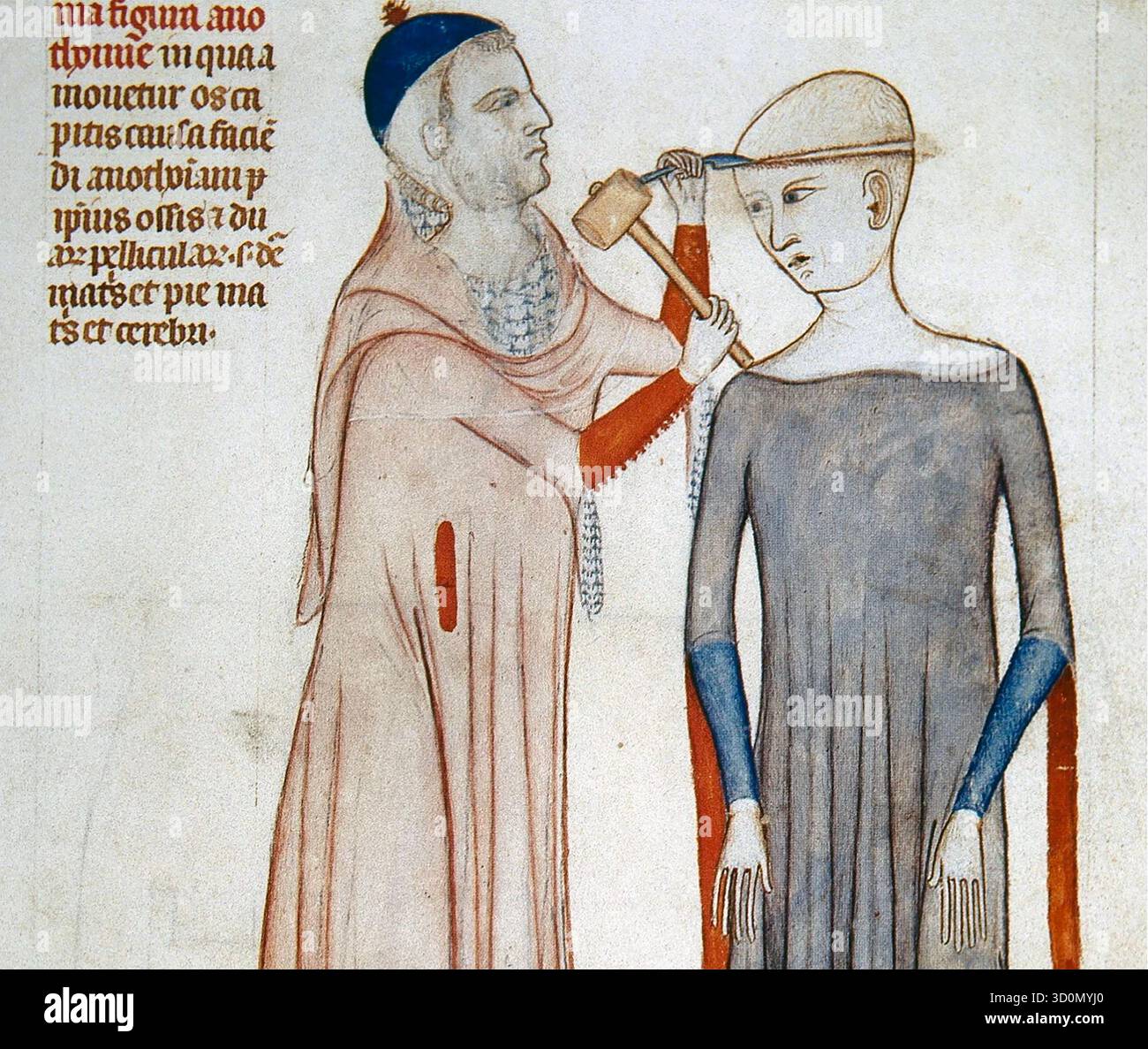 MEDIEVAL MEDICINE Illustration of trepanning from a 1345 manuscript by ...