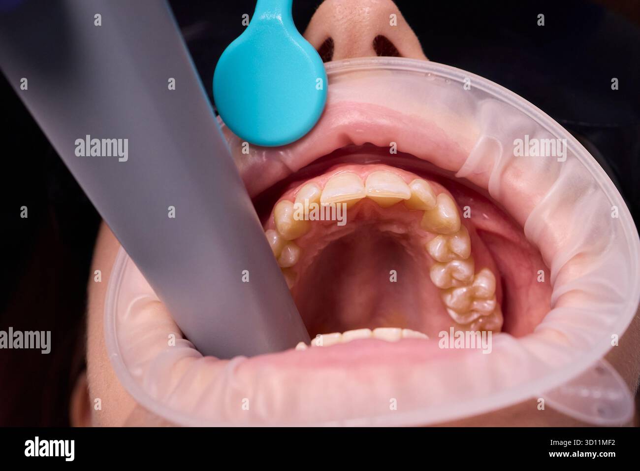 Comprehensive Dental Examination Utilizing Advanced Intraoral Scanner ...