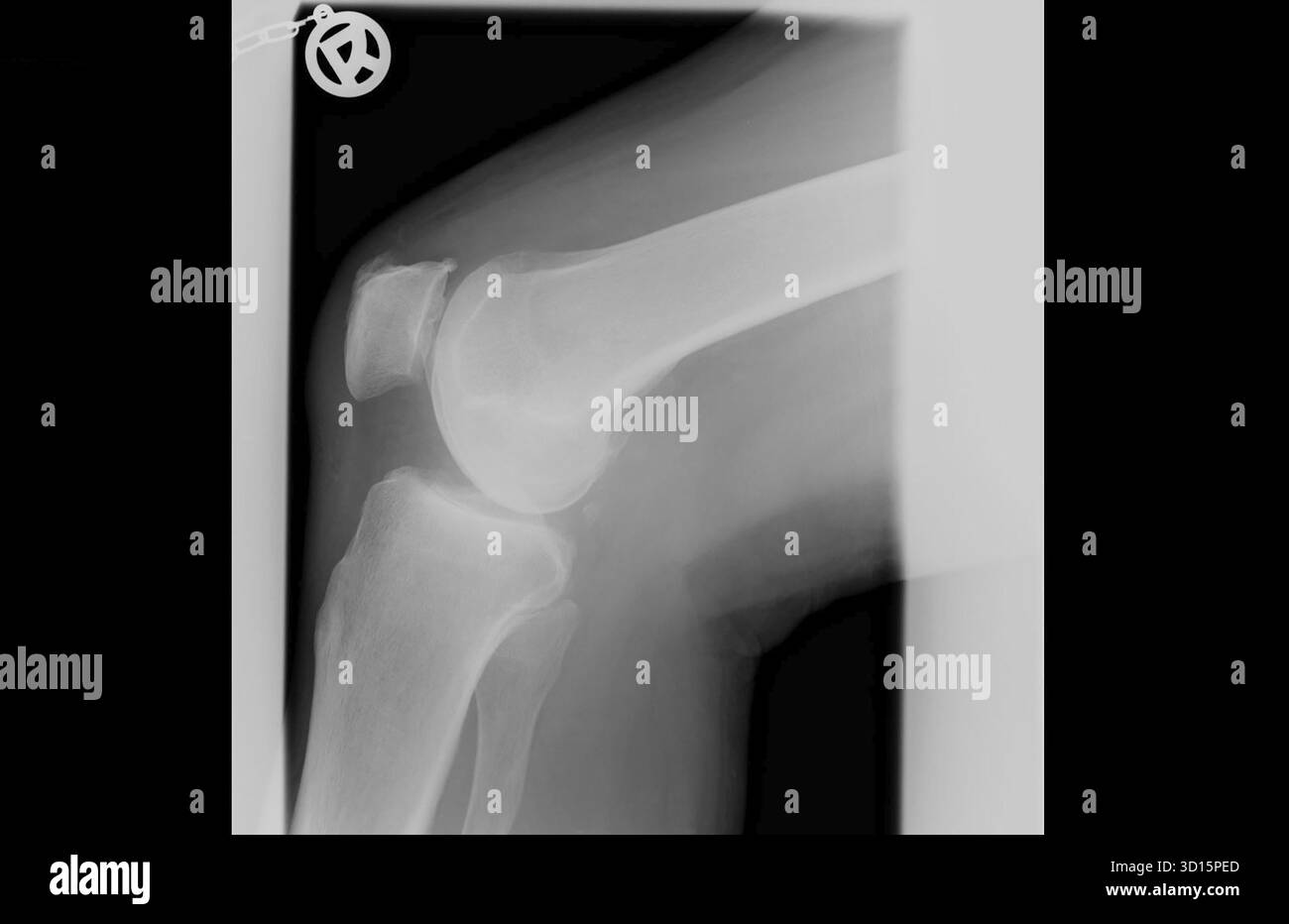 Negative X-ray image of a human knee rheumatism Negative X ray image of ...