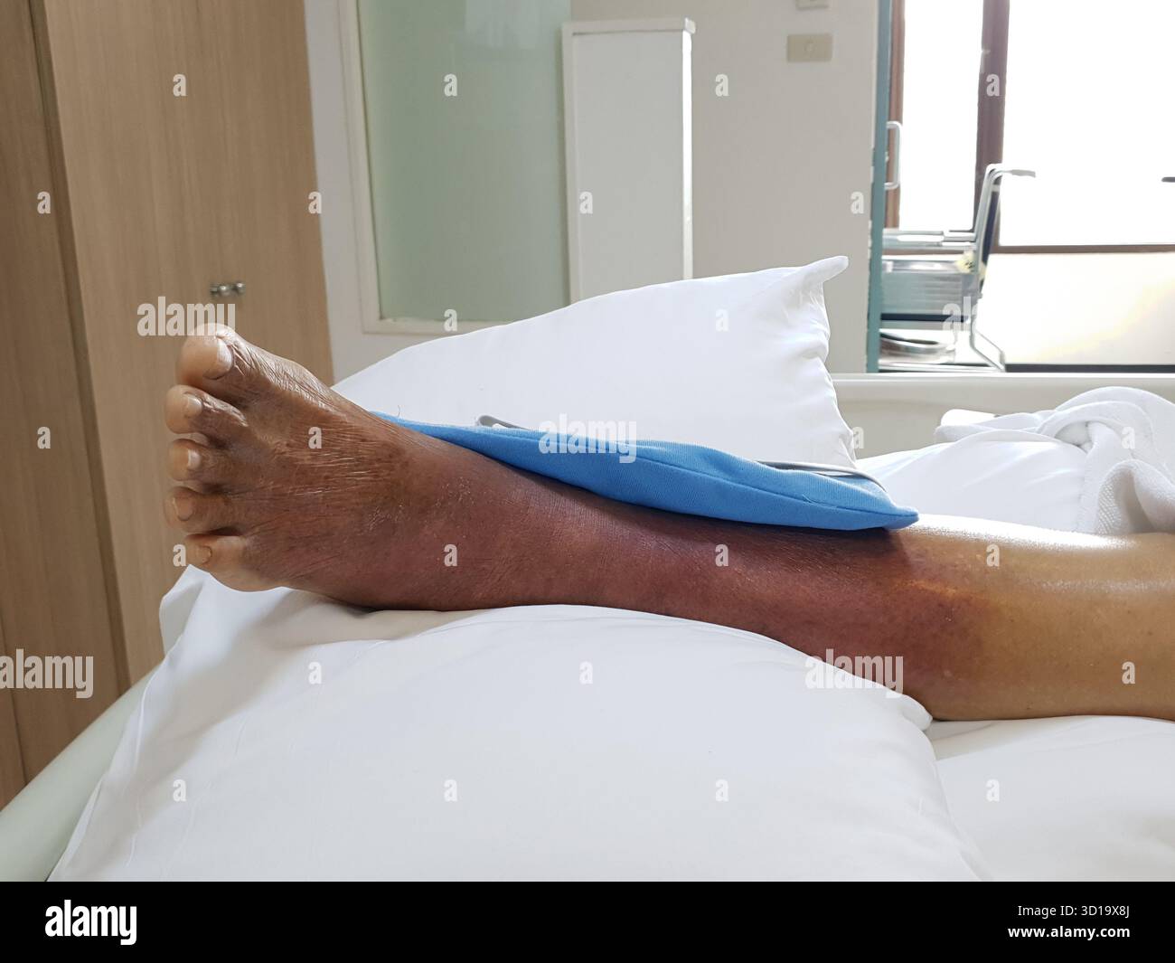 Purpura caused by cancer on leg is side effect of chemotherapy or ...