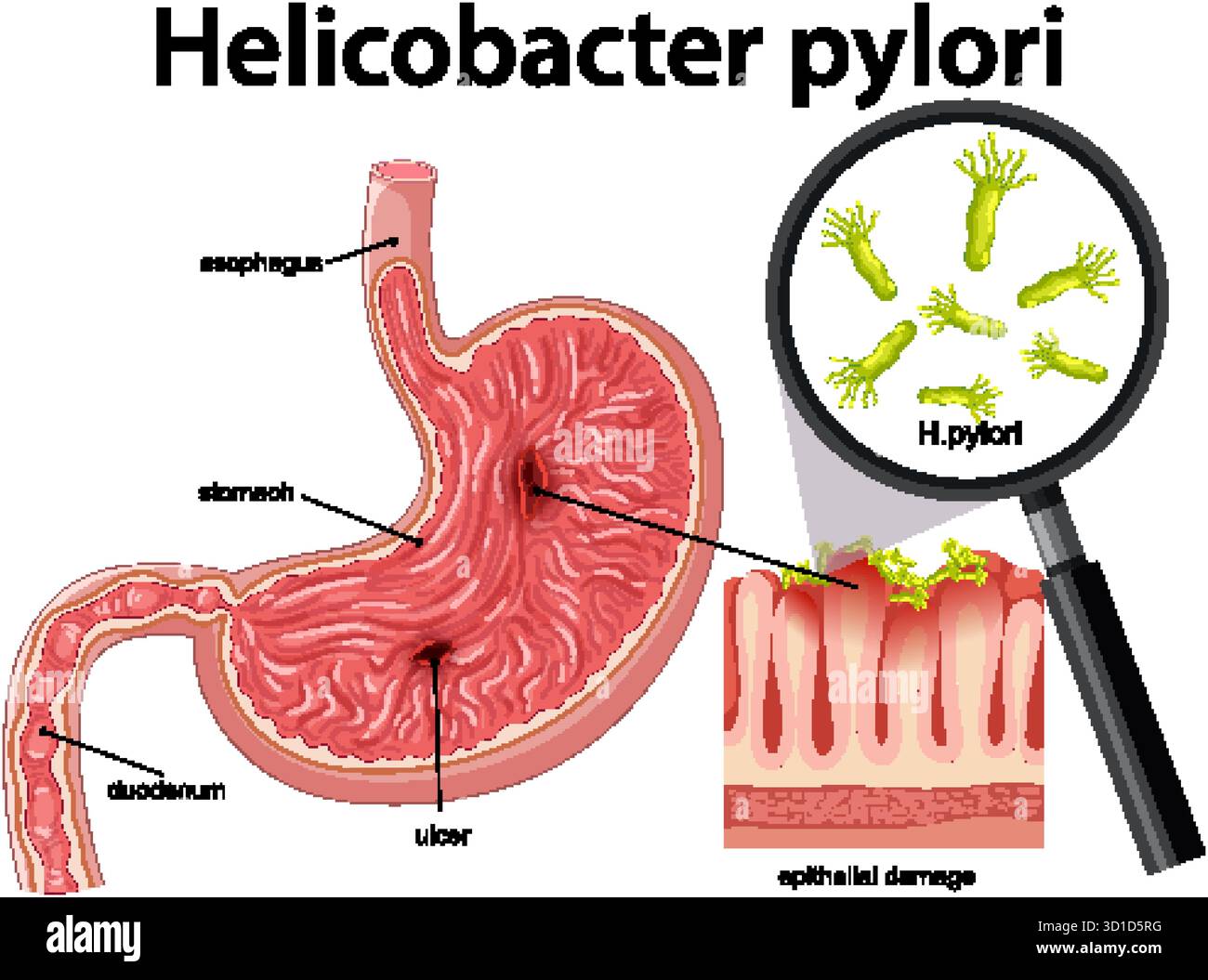 Vector diagram showing H. pylori bacteria, stomach ulcer, epithelial ...