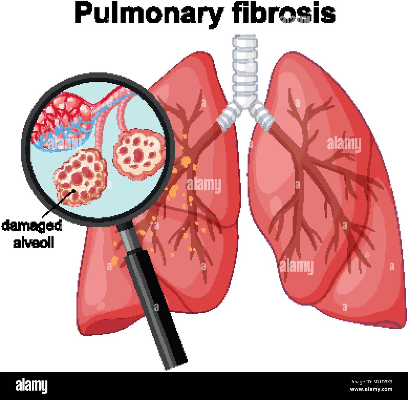 Vector lungs with magnified view of alveoli damage, flat style, labeled ...