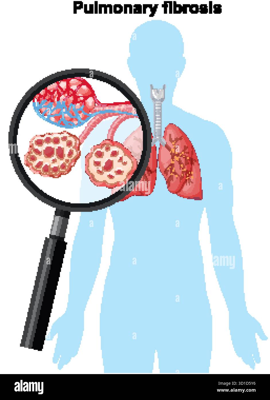 Vector illustration of pulmonary fibrosis with magnified alveoli ...