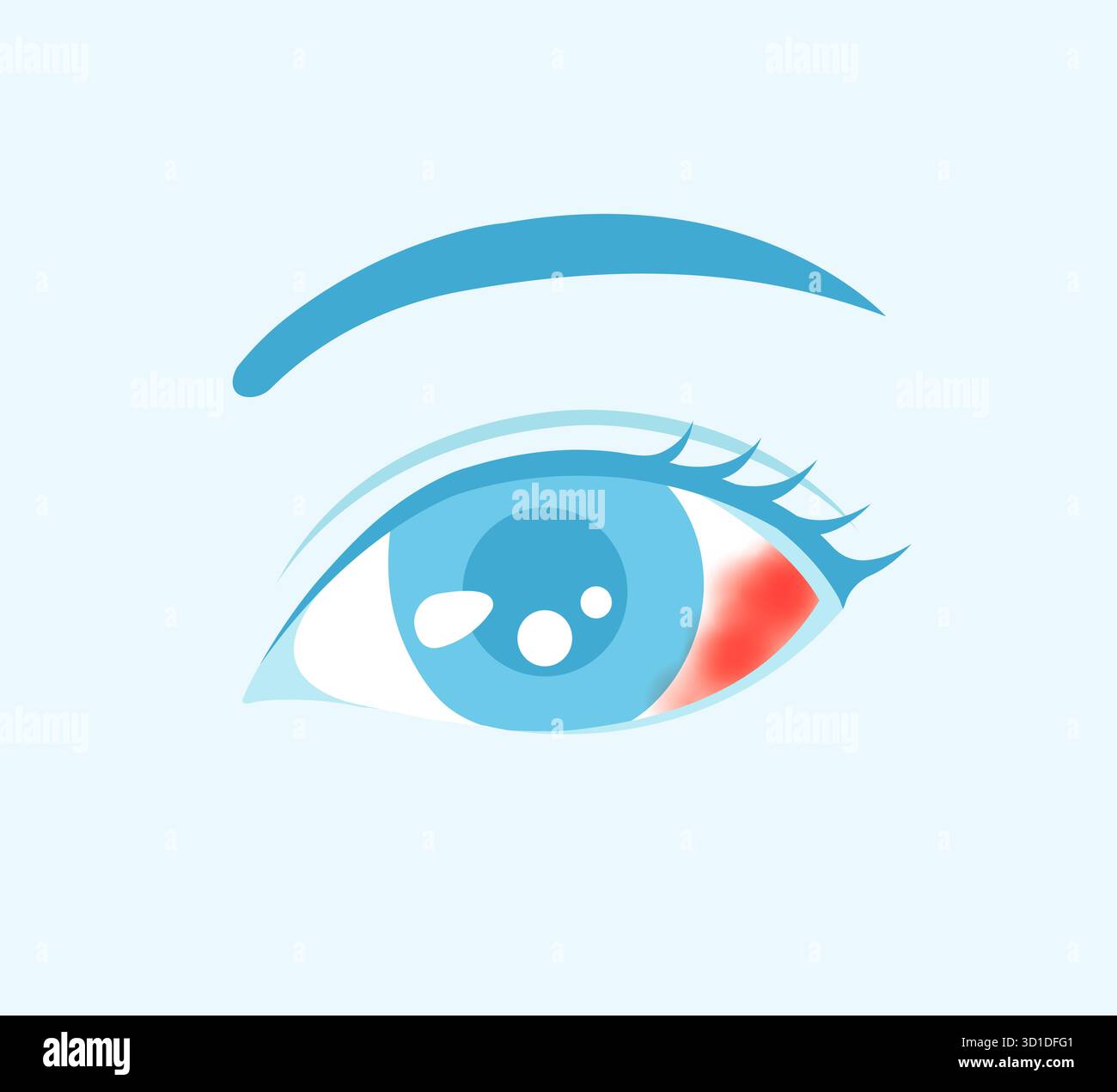Human eye subconjunctival hemorrhage Stock Vector Images - Alamy