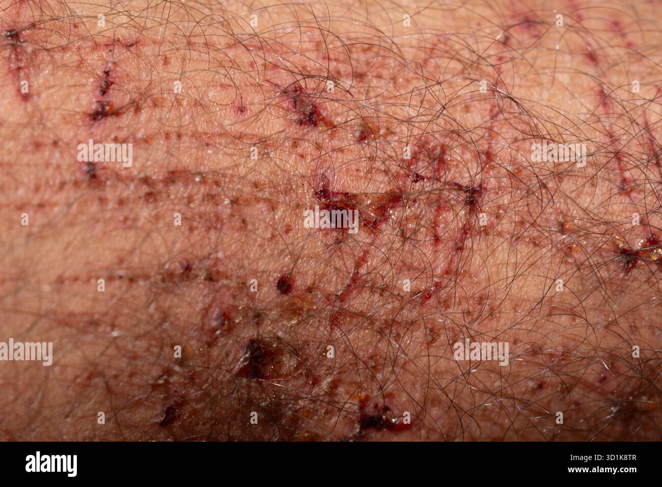Skin injury with multiple scratches. Irritated leg with bleeding wounds ...