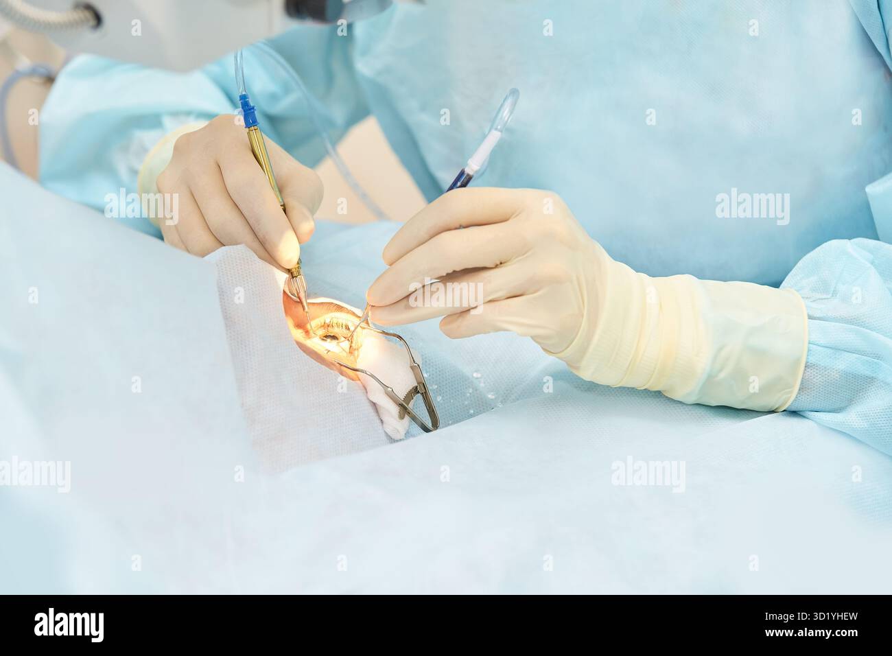 Ophthalmology laser microscope operation. Doctor in clinic. Patient eye ...