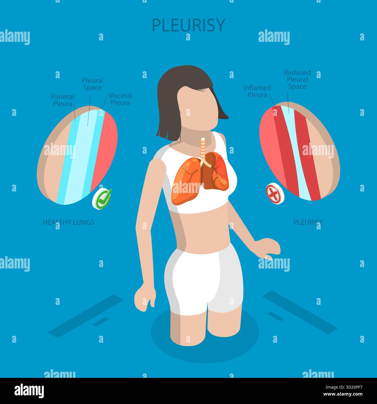 3D Isometric Flat Illustration of Pleurisy Or Pleuritis Disease ...
