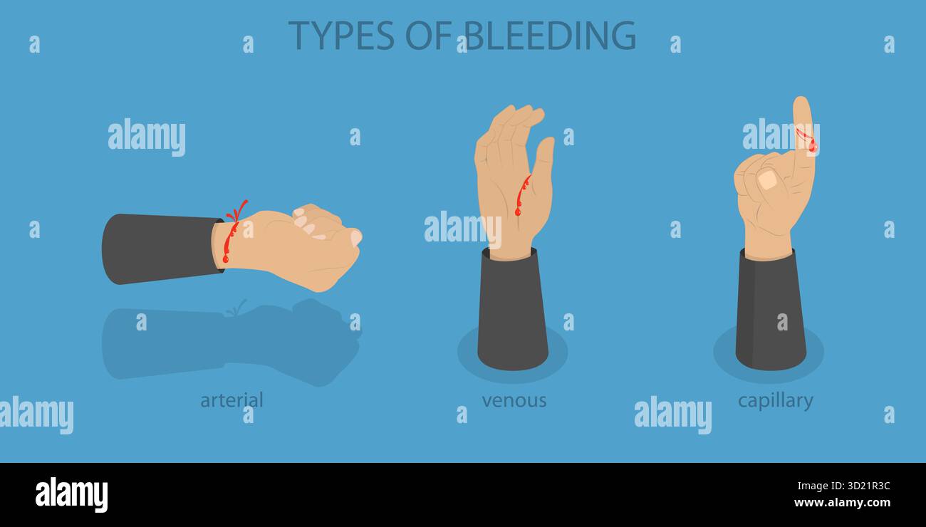 Arterial bleeding man hi-res stock photography and images - Alamy