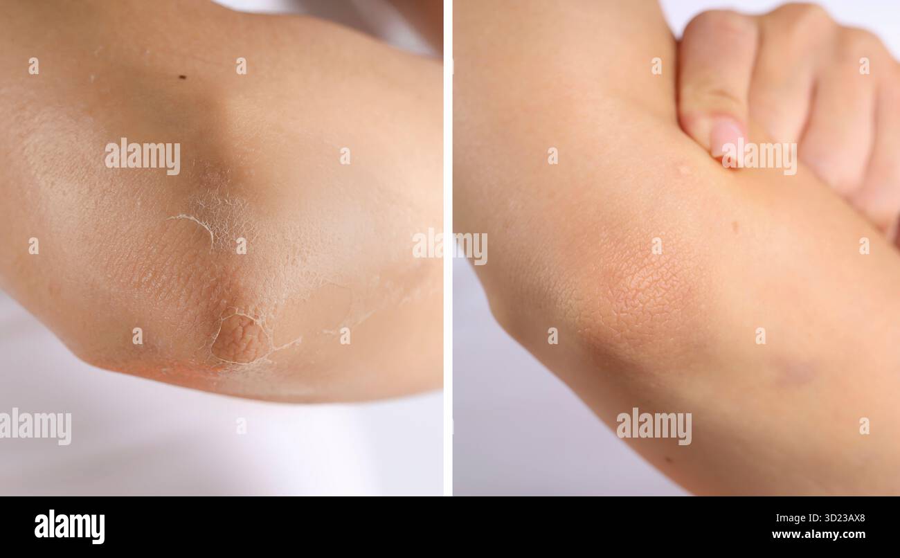Woman with dry skin on elbow before and after moisturizing treatment ...
