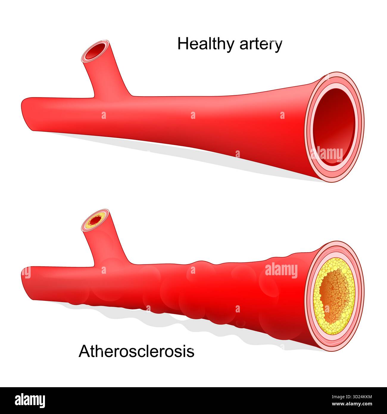 Atherosclerosis. Healthy artery with normal blood flow and blood vessel with Arteriosclerotic ...