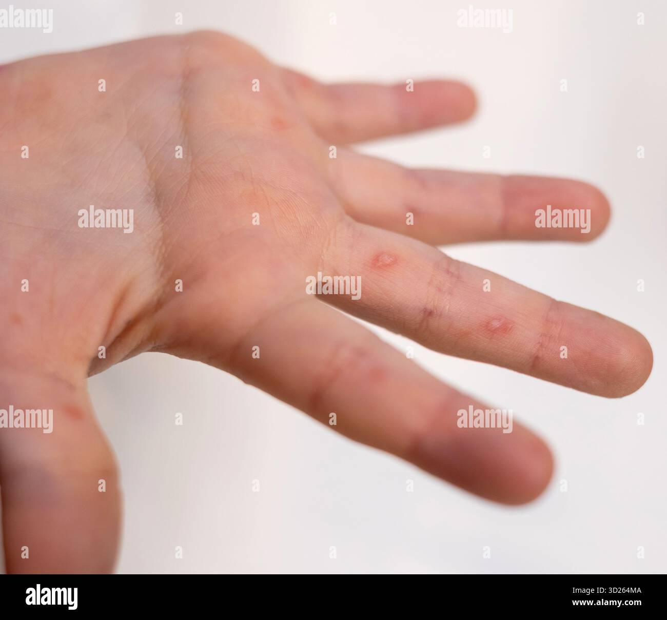 Child foot red itchy hi-res stock photography and images - Alamy