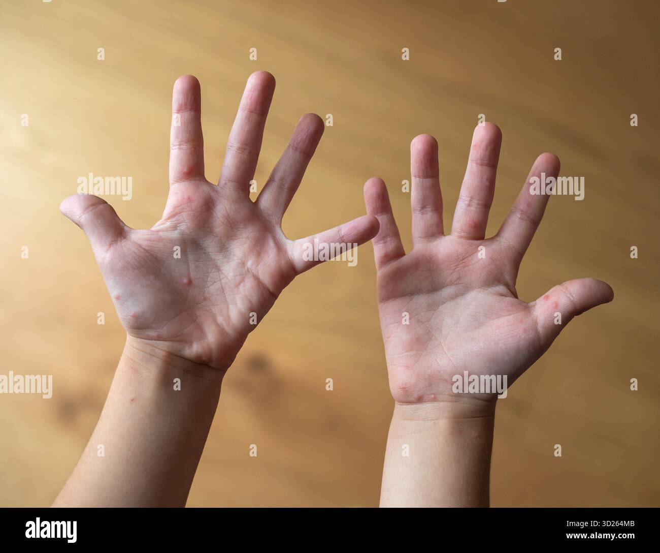 Child's hands showing typical red spots and blisters on palms and ...