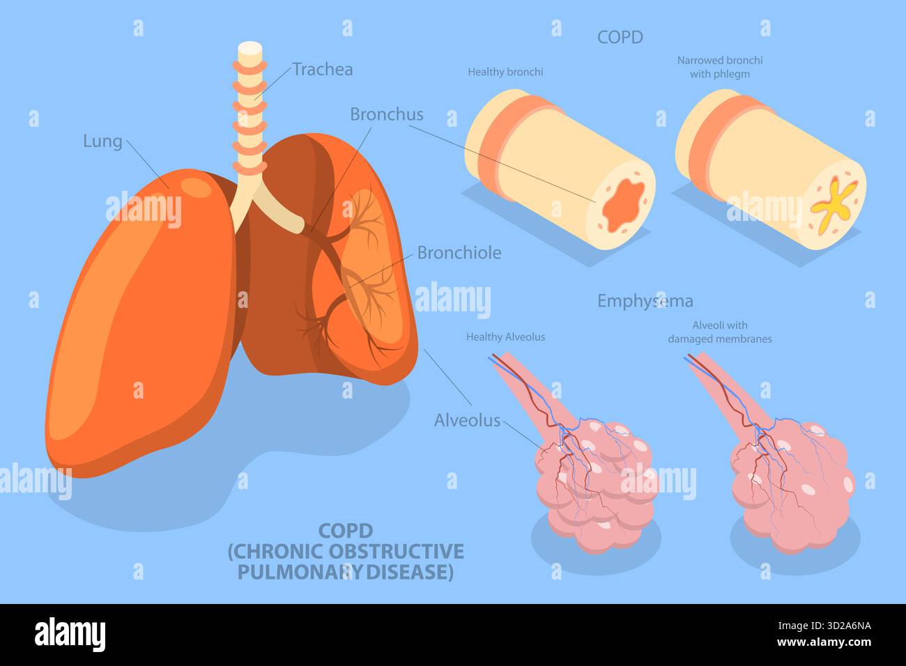 3D Isometric Flat Conceptual Illustration of COPD, Chronic Obstructive ...