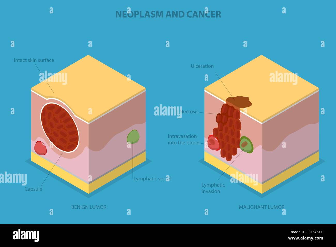 3D Isometric Flat Conceptual Illustration of Neoplasm And Cancer, Tumor ...