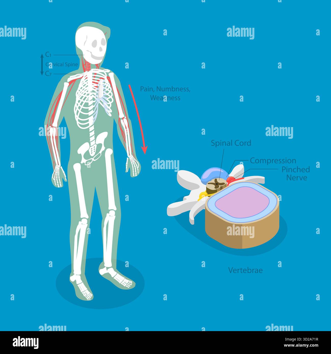 3D Isometric Flat Illustration of Cervical Radiulopathy, Traumatic ...