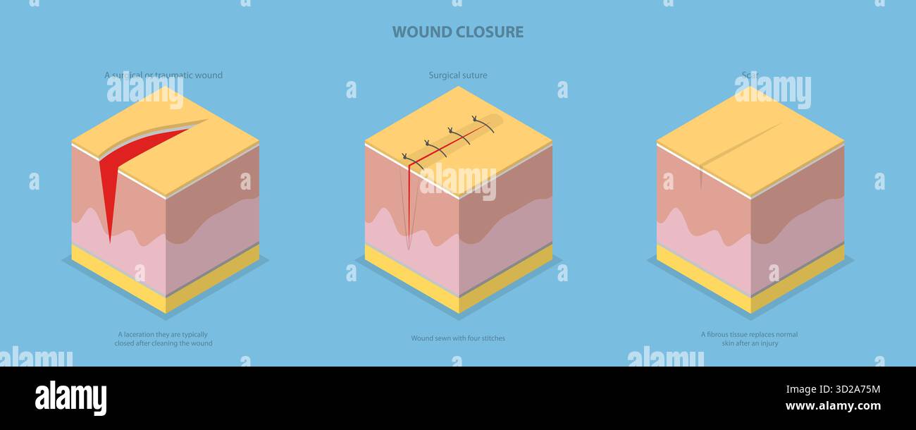 3D Isometric Flat Conceptual Illustration of Wound Closure, Tissue ...