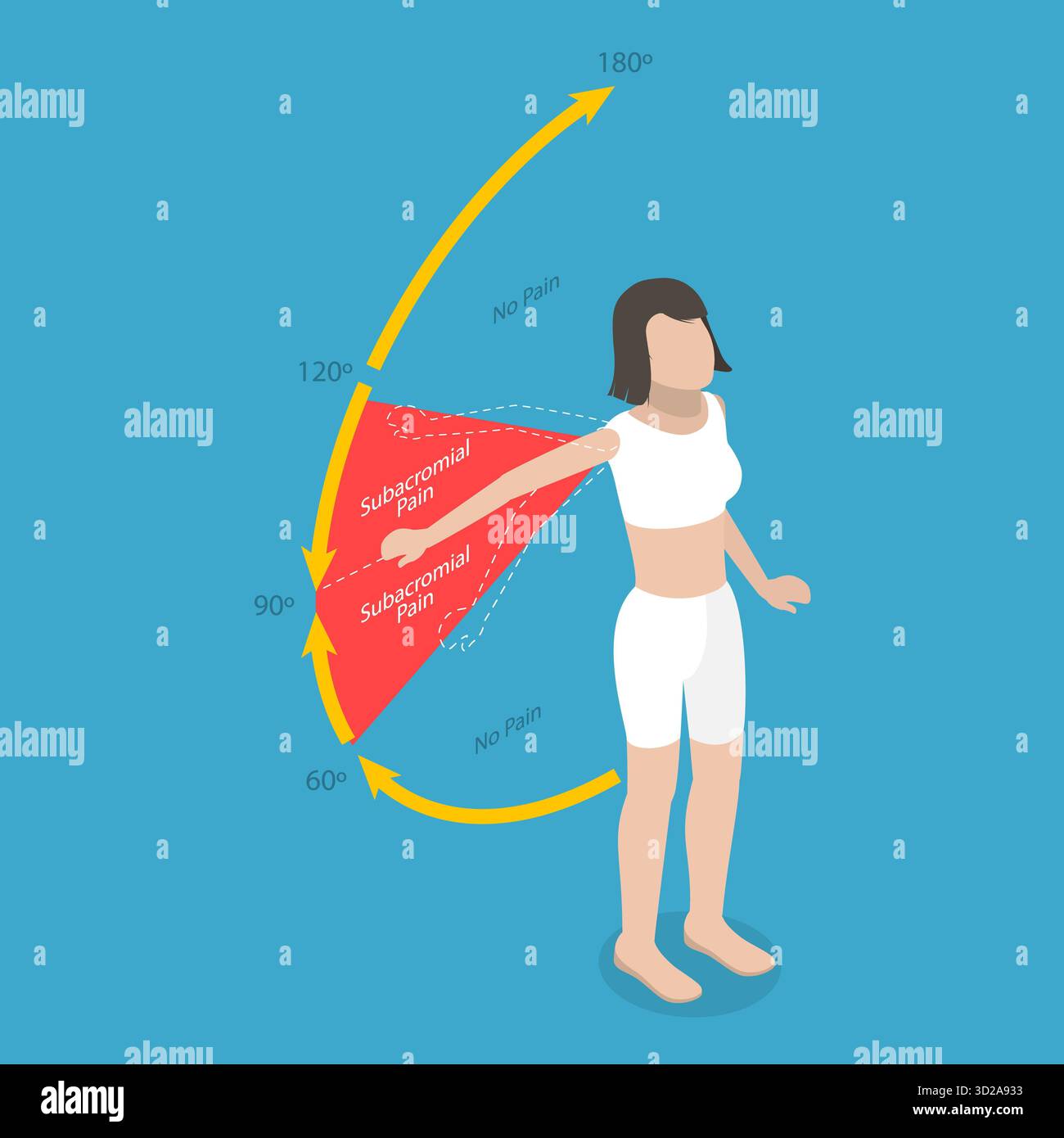 3D Isometric Flat Conceptual Illustration of Painful Arc Test, Rotator ...