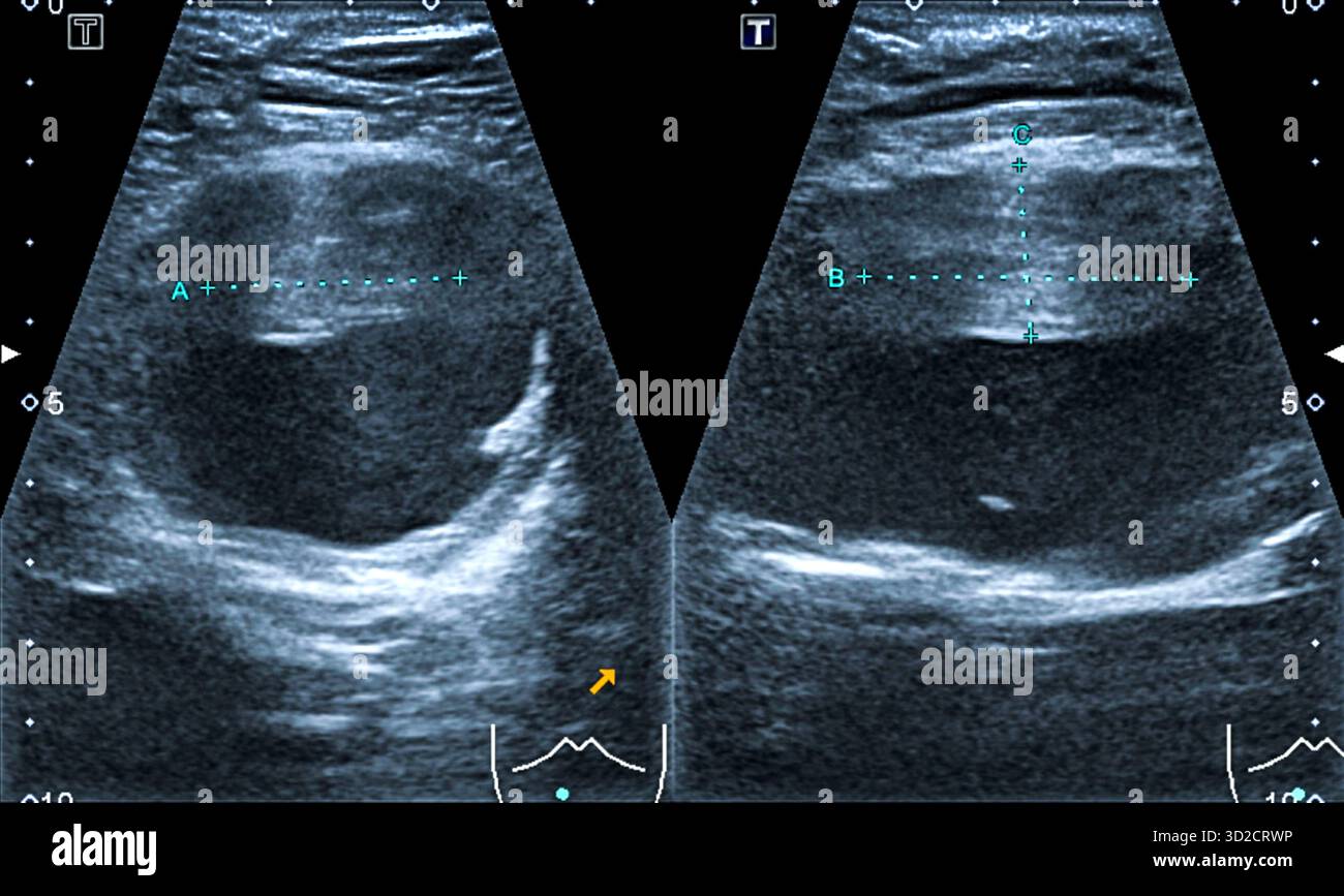 Ultrasound scan of a patient's abdominal aorta (segment of the body's ...