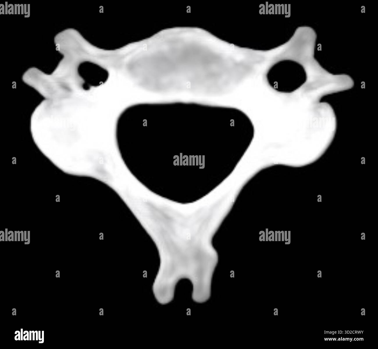 Computed tomography (CT) scan of a cervical (neck) vertebrae (bone ...