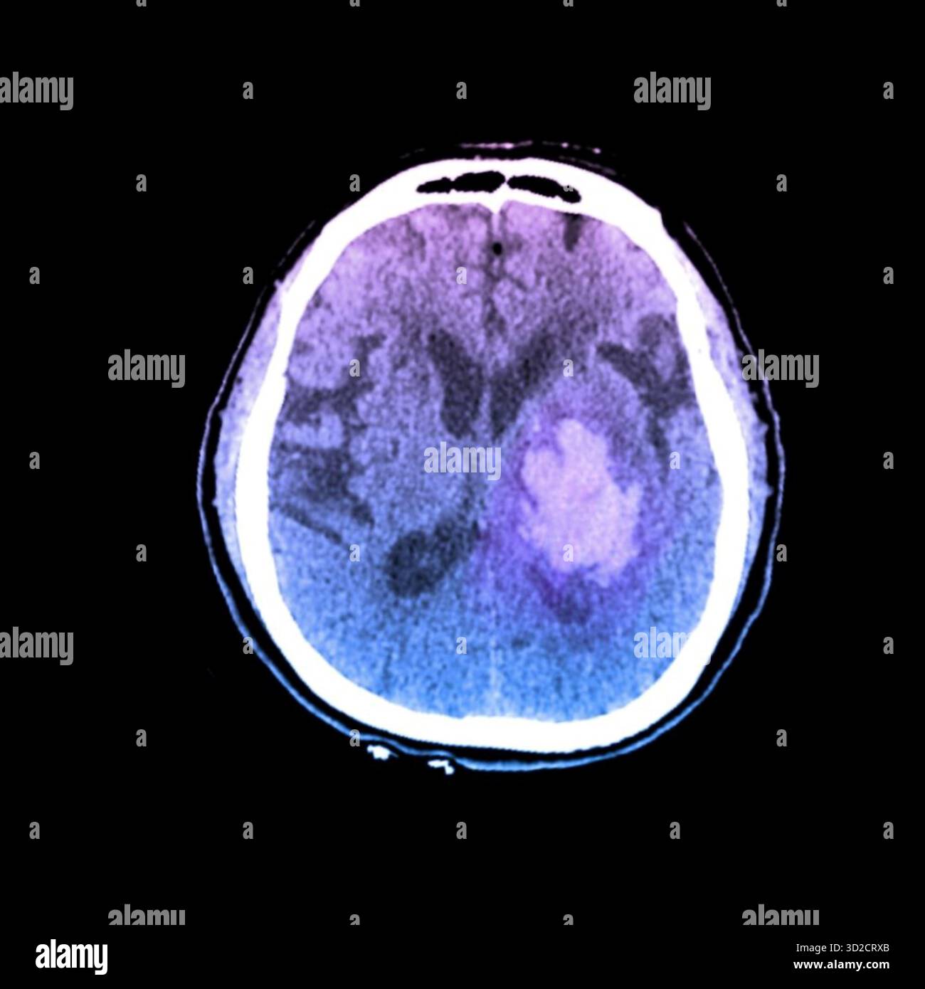 Body bleed hi-res stock photography and images - Alamy