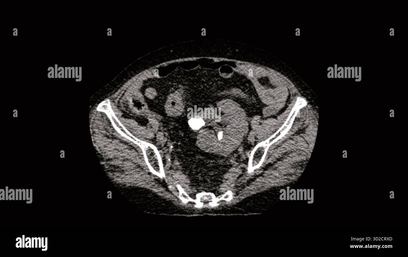 Computed tomography (CT) scan of an ectopic (abnormally positioned ...