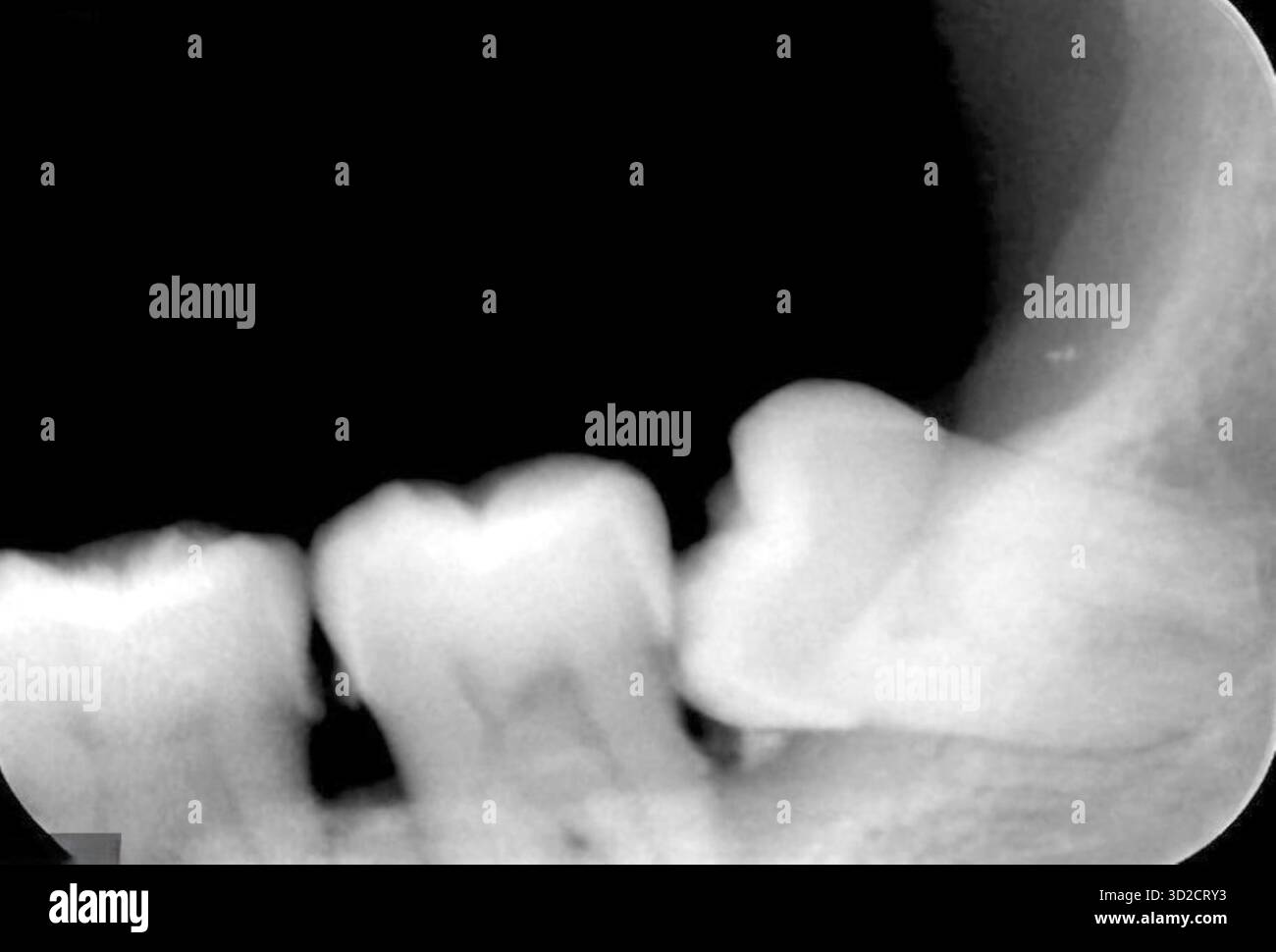 Impacted wisdom tooth, X-ray Stock Photo - Alamy