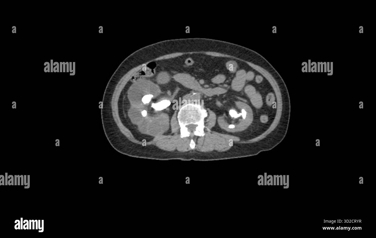 Computed tomography (CT) scan of a patient with bilateral kidney stoned ...