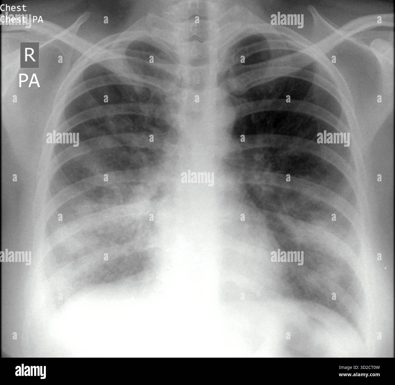 X-ray of the chest of a patient with pneumonia. Pneumonia is most ...