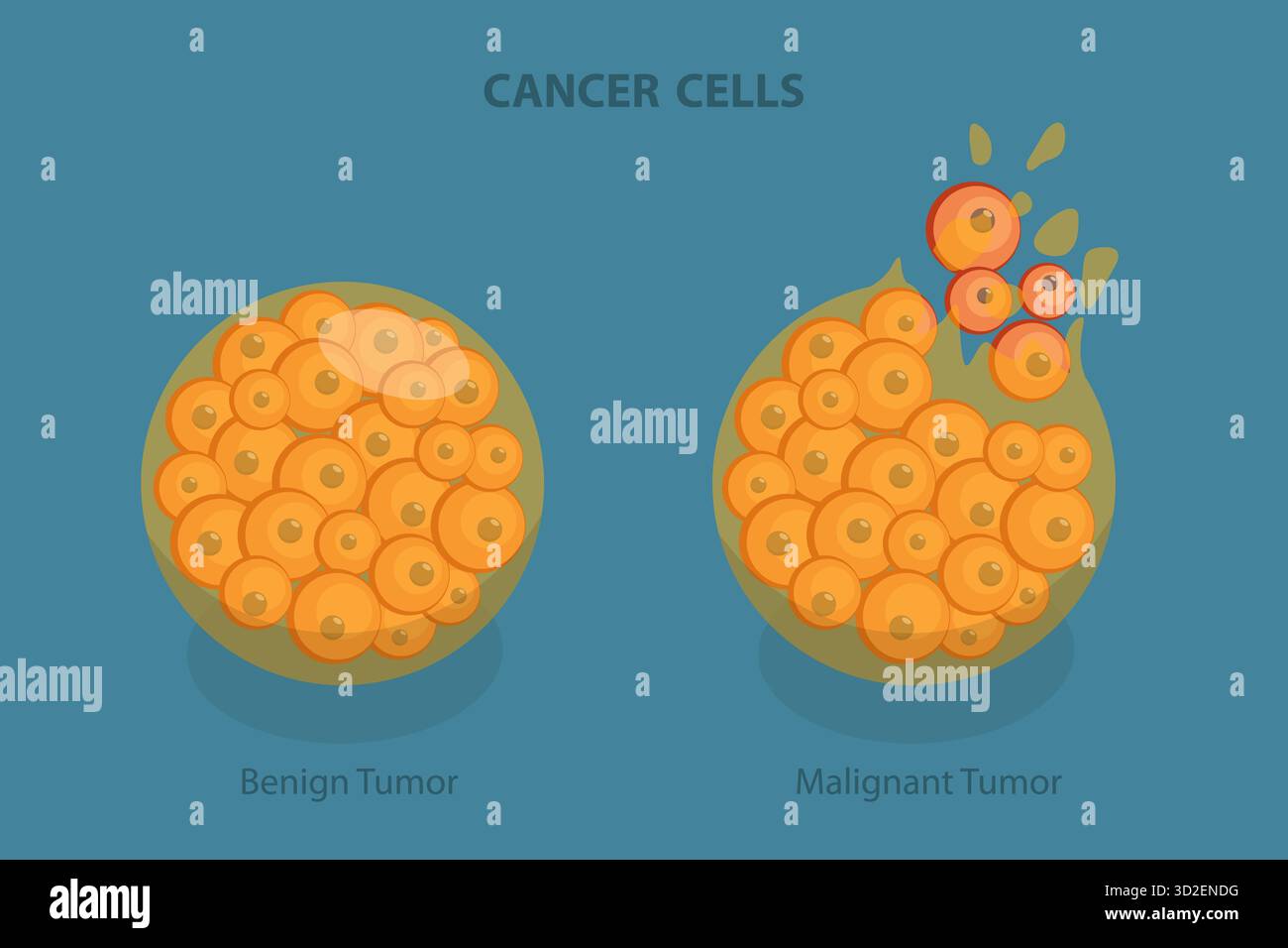 3D Isometric Flat Illustration of Cancer Cells, Tumor Development Stock ...