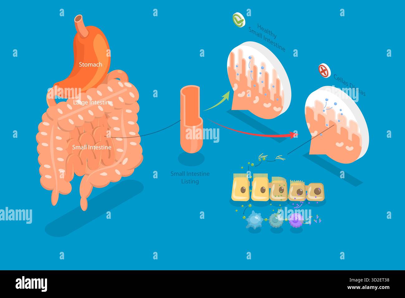 3D Isometric Flat Conceptual Illustration of Celiac Disease ...
