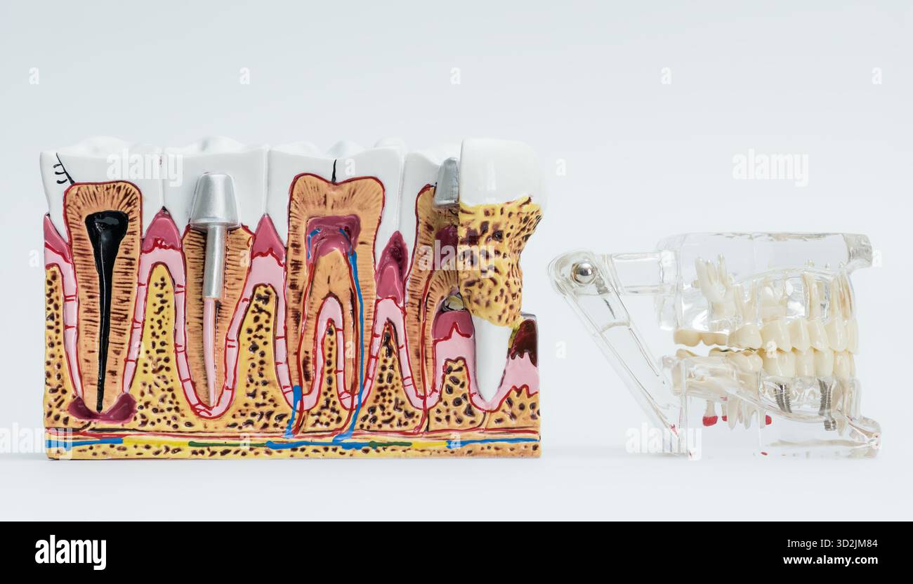 Side-by-side dental models showing detailed cross-sections with decay ...