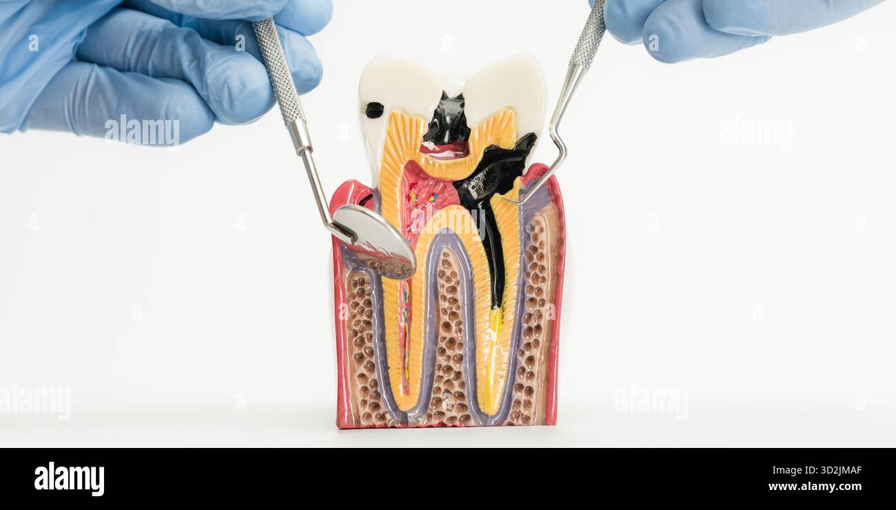 Gloved hands use dental tools to examine a cross-sectional tooth model ...