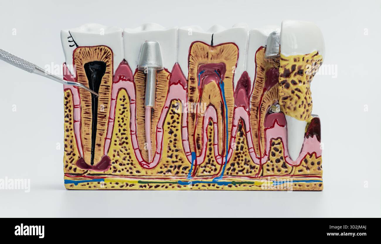 Detailed cross-sectional model of human teeth showing cavities, root ...
