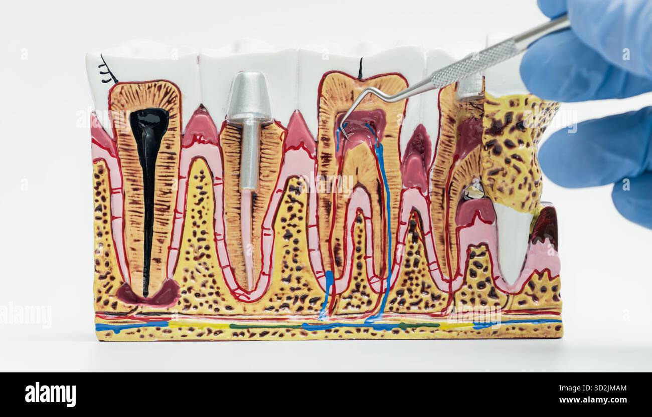 Gloved hand uses dental tool to examine cross-sectional tooth model ...