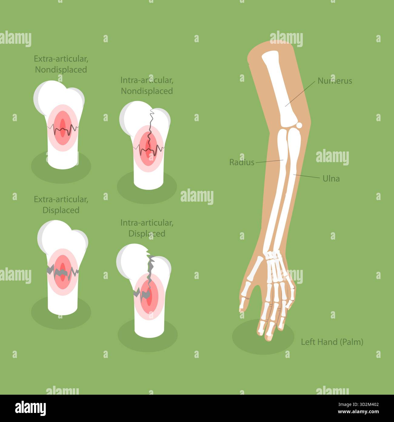 3D Isometric Flat Conceptual Illustration of Distal Radius Fracture ...