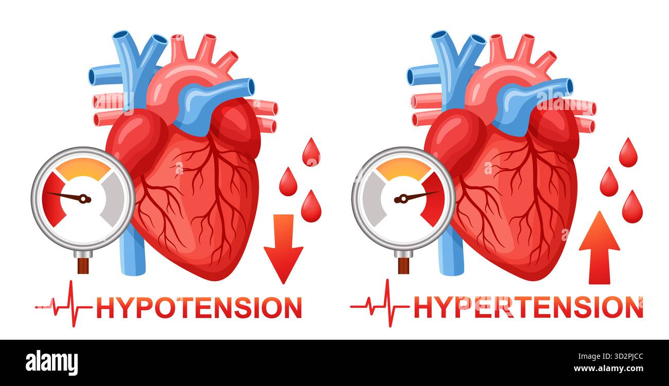 Hypotension vector vectors Stock Vector Images - Alamy