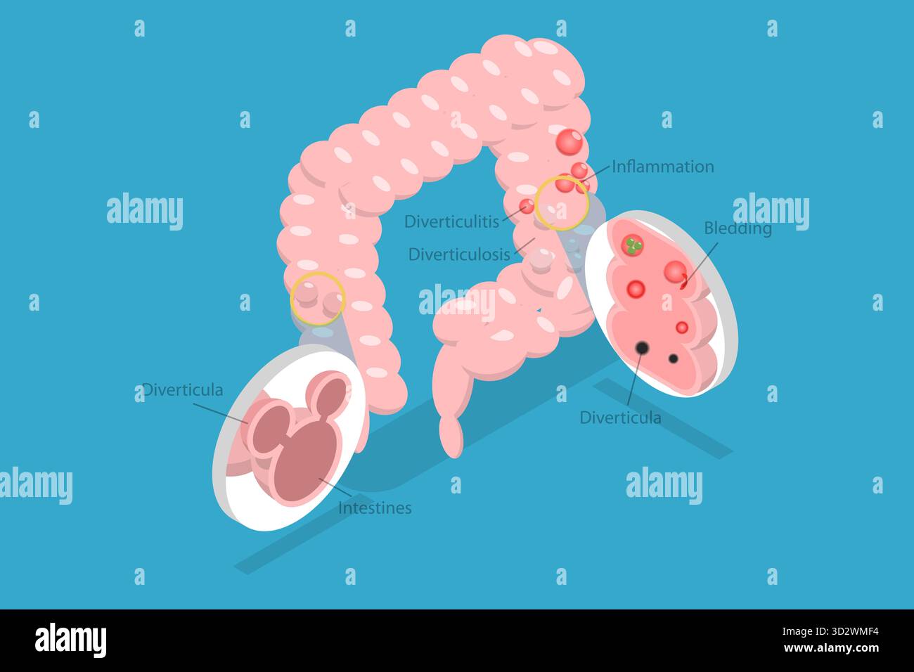 Diverticulitis hi-res stock photography and images - Alamy