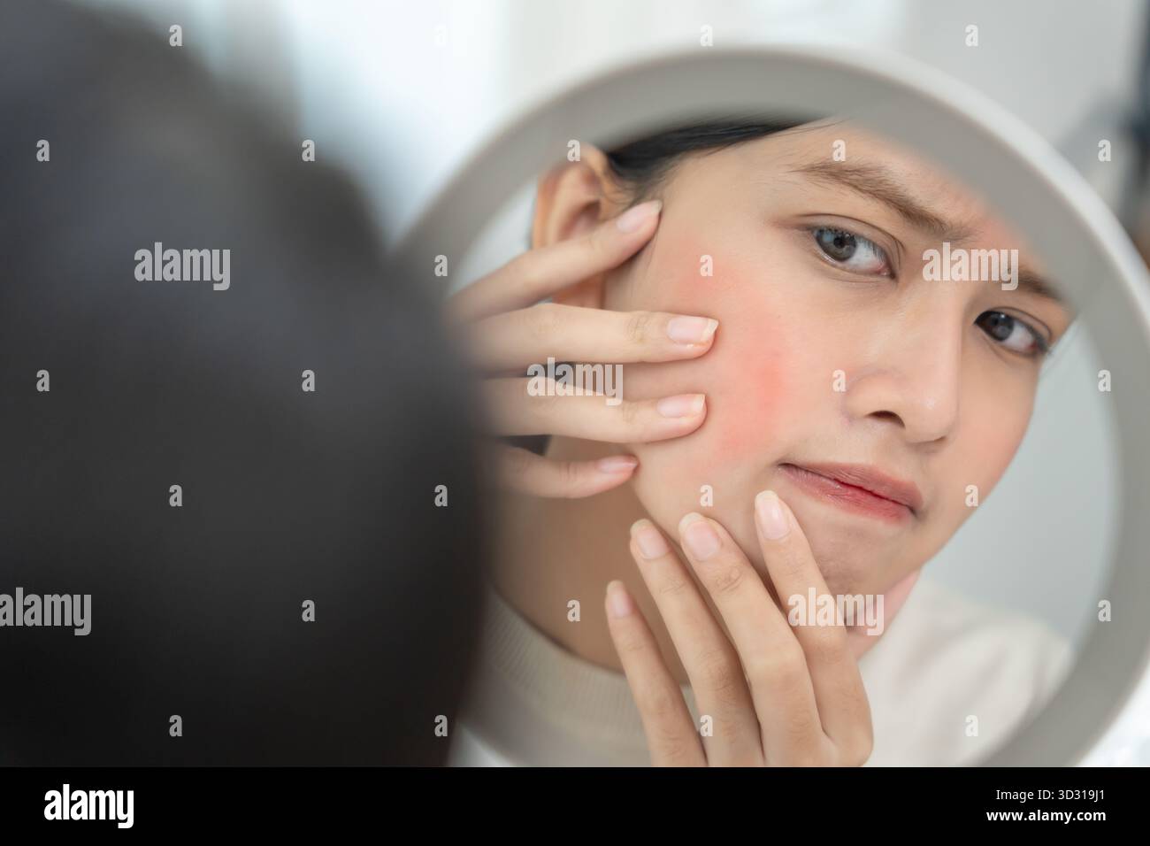Young woman are worried about faces Dermatology and allergic to ...