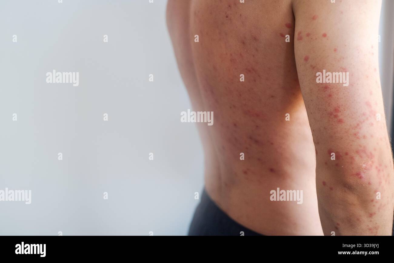 Man with many blisters on body some drying and forming crusts typical ...