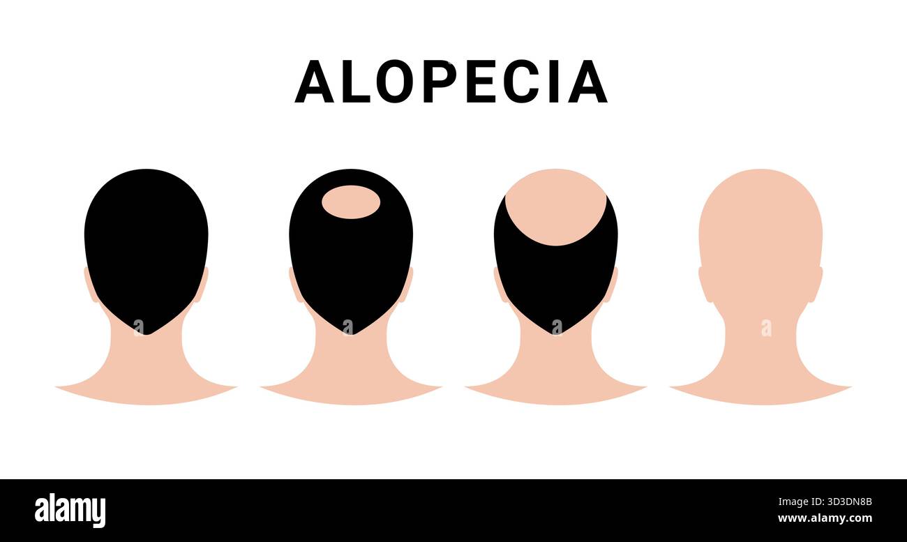 Hair alopecia head man. Bald vector head alopecia transplant hair male ...