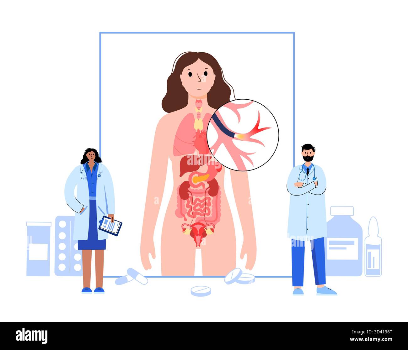 Illustration of a bronchoscopy procedure. This involves the insertion ...