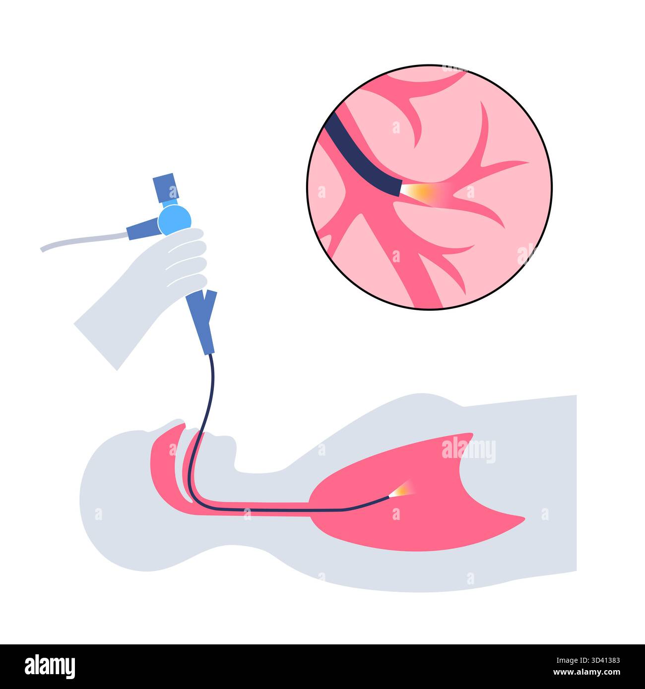 Illustration of a bronchoscopy procedure. This involves the insertion ...