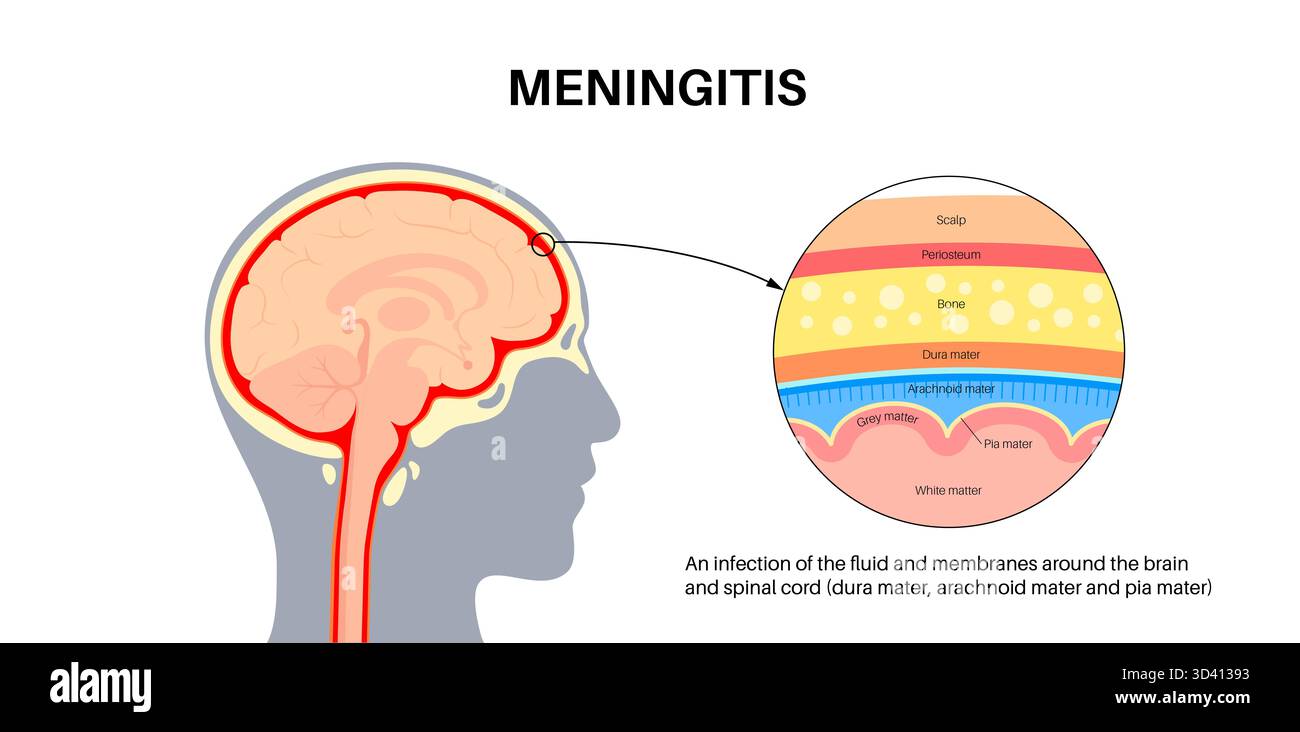Illustration of meningitis. This is an inflammation of the protective ...