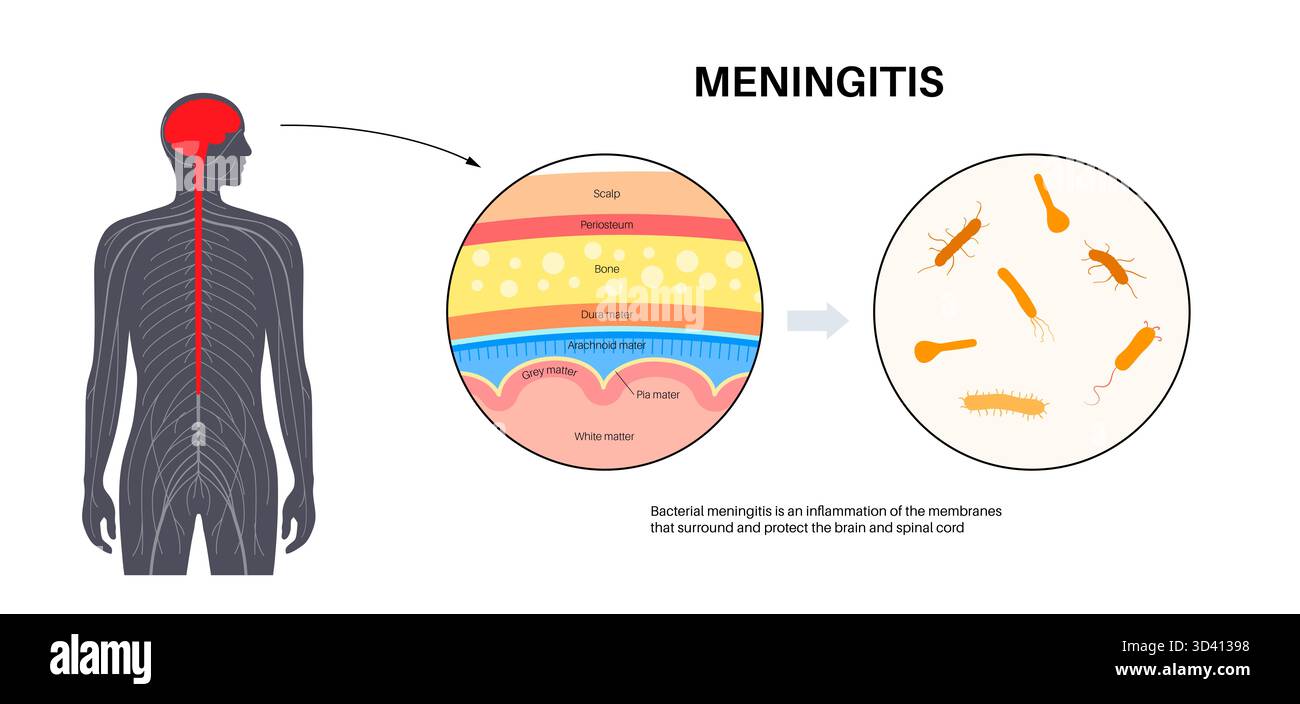 Illustration of meningitis. This is an inflammation of the protective ...