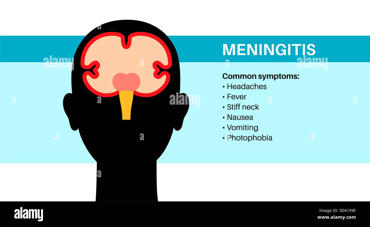 Illustration of meningitis. This is an inflammation of the protective ...
