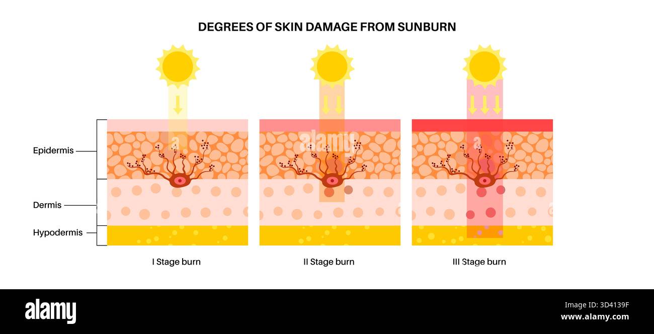 Degrees of skin damage from sunburn hi-res stock photography and images ...