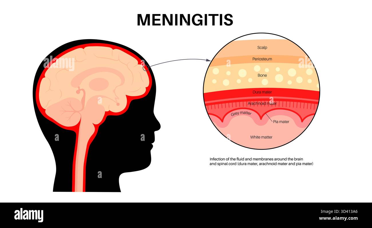 Illustration of meningitis. This is an inflammation of the protective ...