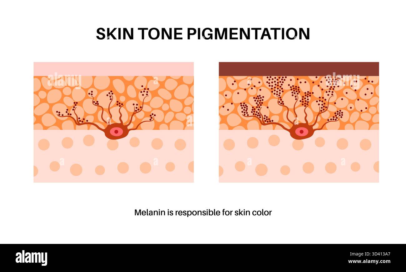 Illustration of skin pigmentation. Melanocytes are specialised cells in ...