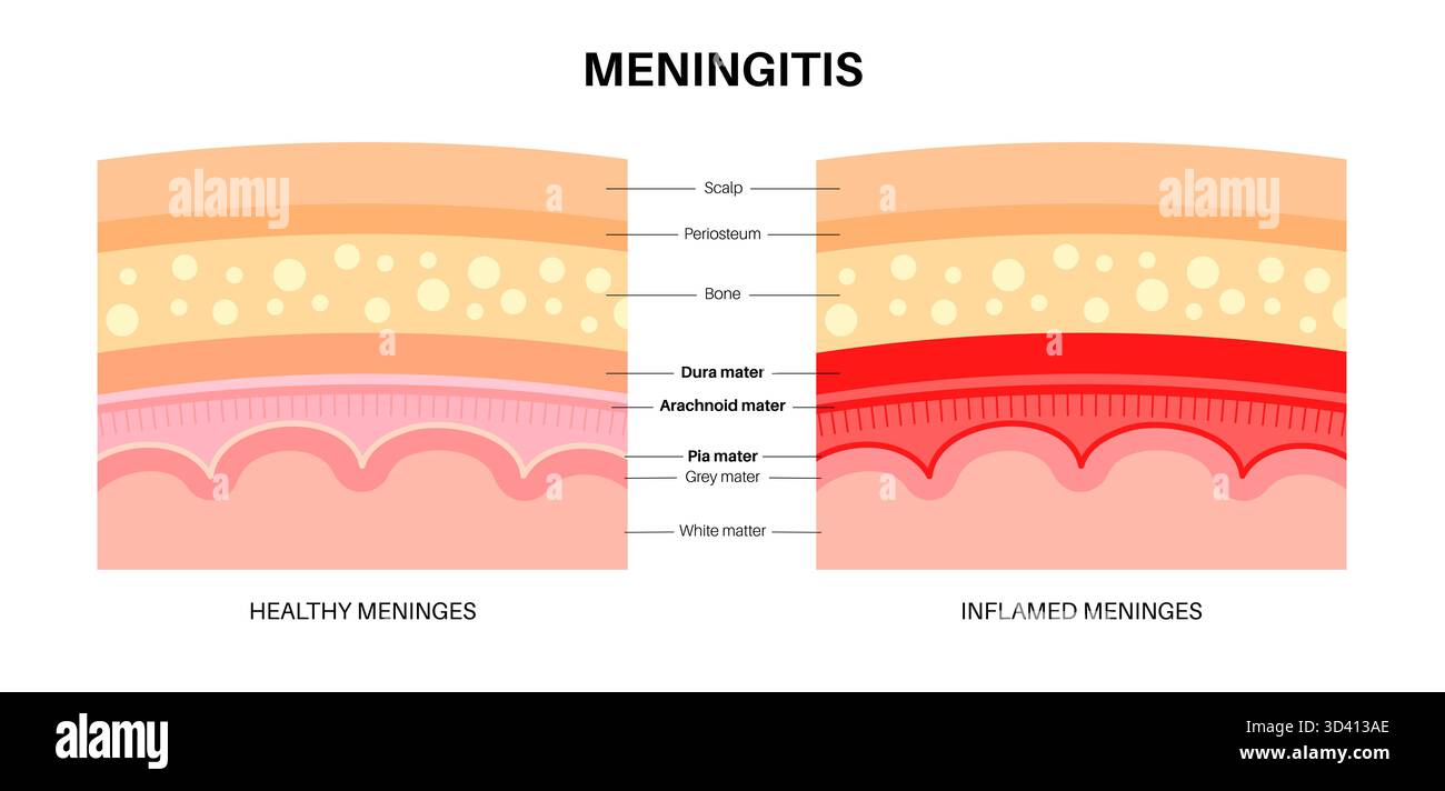 Illustration of meningitis. This is an inflammation of the protective ...