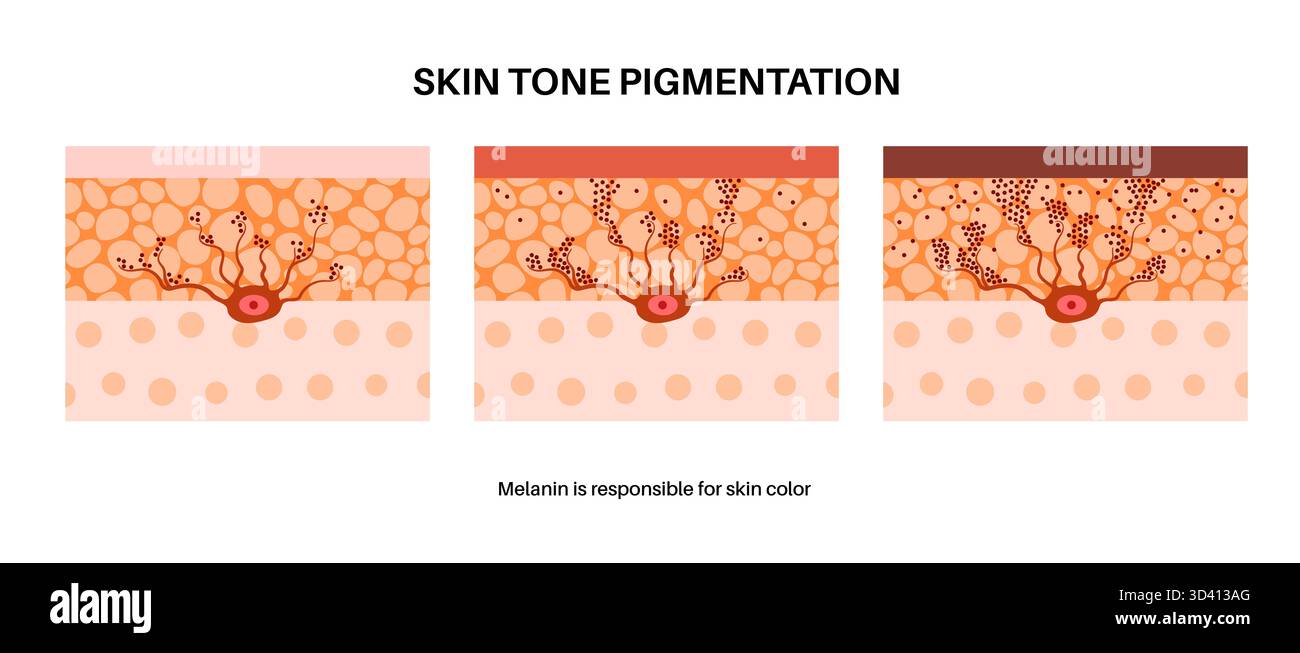 Illustration of skin pigmentation. Melanocytes are specialised cells in ...